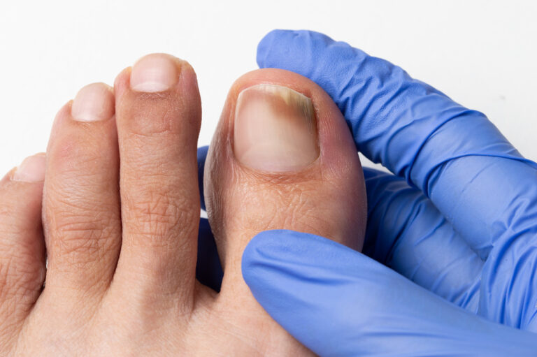 Nail Trauma & Growth Changes | Westford Dermatology